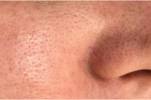 Skin Needling - Results Laser Clinic