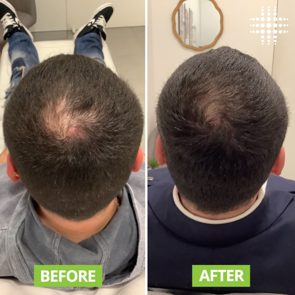 Hair Regrowth Therapy Before and After Results - Results Laser Clinic