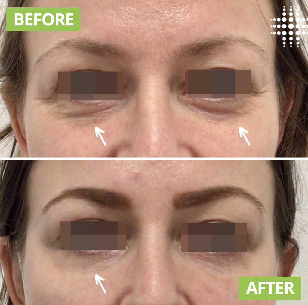 Skin and Eye Rejuvenation Before and After Results - Results Laser Clinic