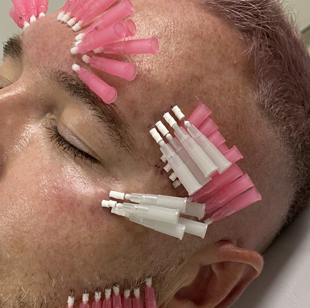 The Ultimate Guide to Facial Threads - Results Laser Clinic