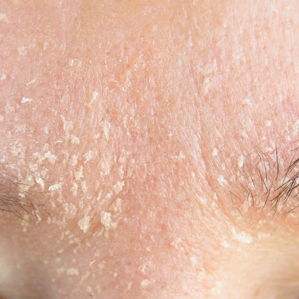 Dry Skin vs. Dehydrated Skin - Results Laser Clinic