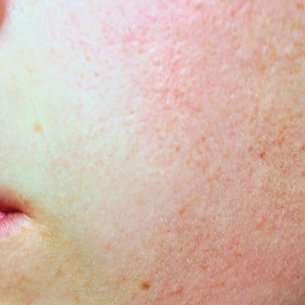 Dry Skin vs. Dehydrated Skin - Results Laser Clinic