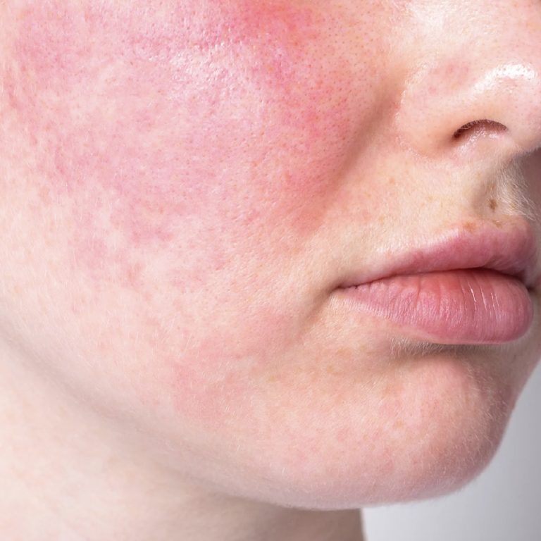 Understanding Skin Conditions and Their Treatments - Results Laser Clinic