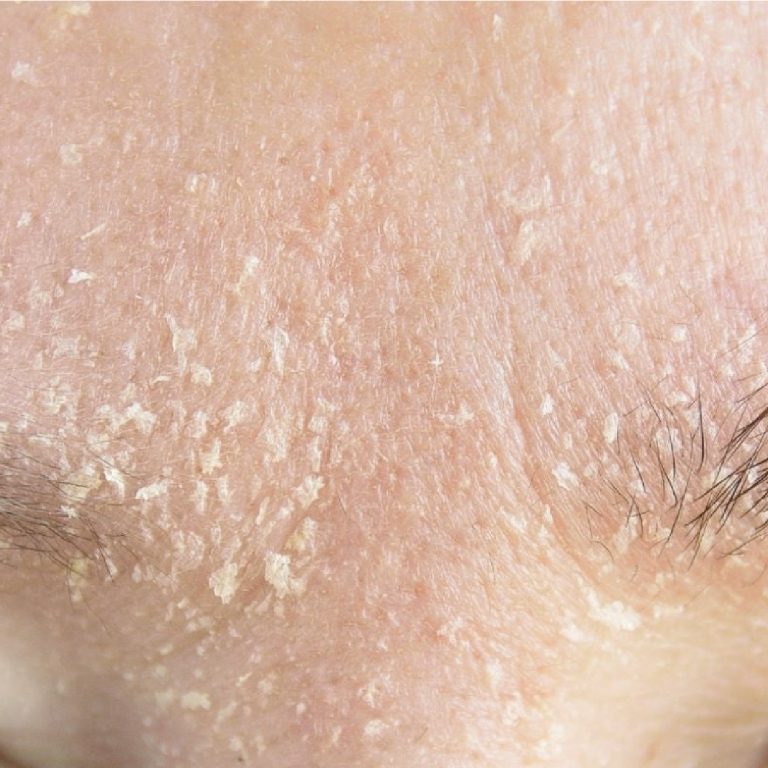 Understanding Skin Conditions and Their Treatments - Results Laser Clinic