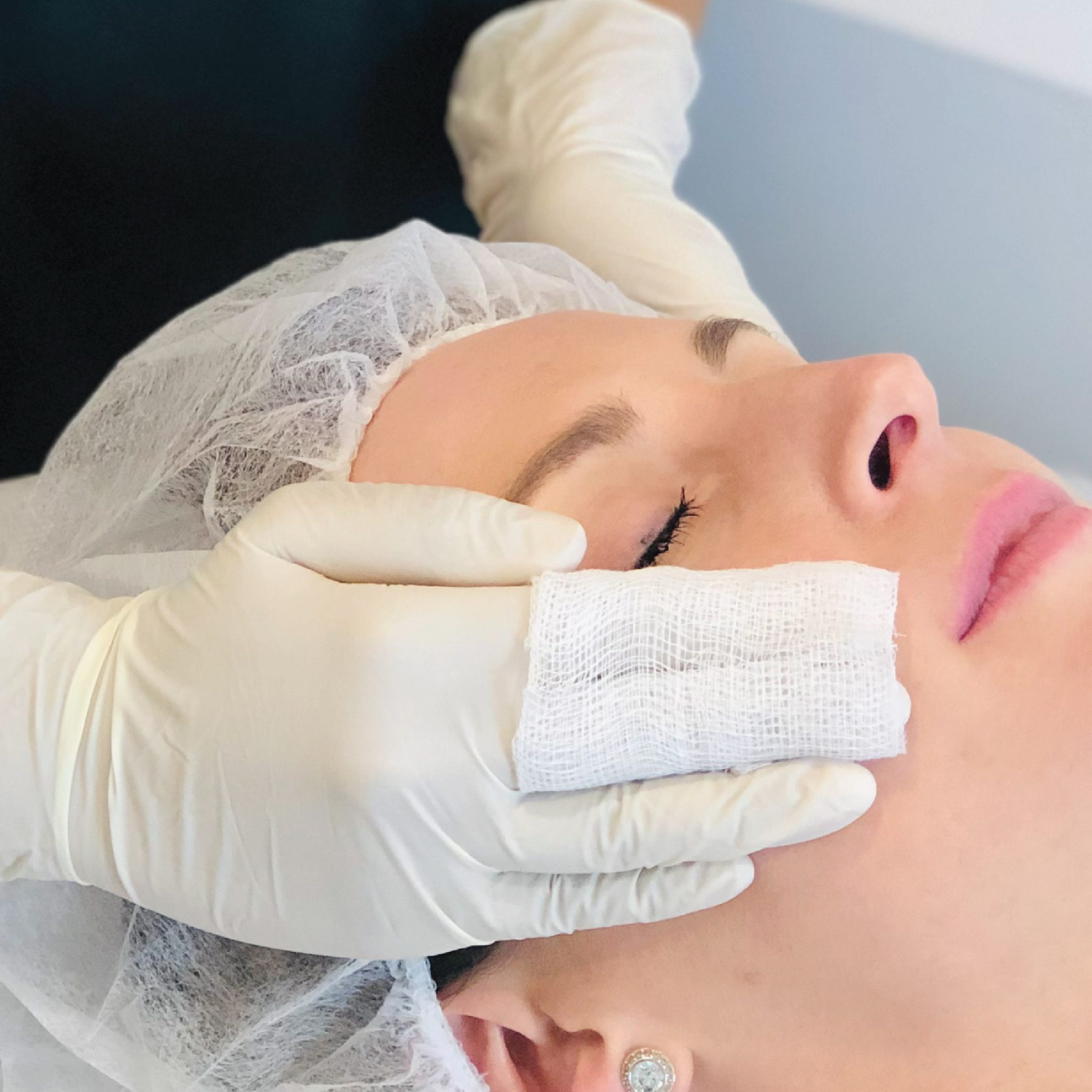 Chemical Peel Benefits: Why Your Skin Will Love It - Results Laser Clinic