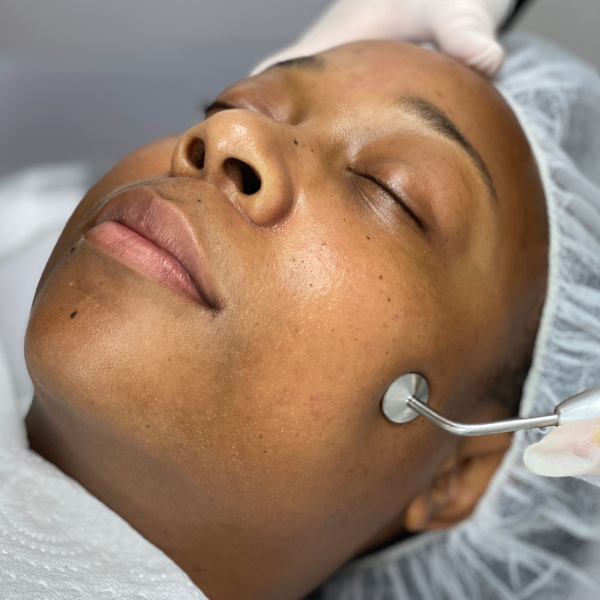 Why Microdermabrasion is the Perfect Treatment for Spring!